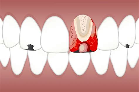 Qué es la pulpitis Síntomas tipos y tratamientos COI Clinica Dental