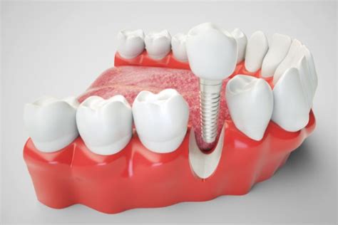 Partes de un implante dental Conrado Andrés Clínica dental y