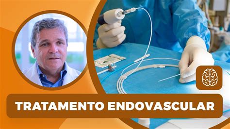 AVC Como Funciona O Tratamento Endovascular YouTube