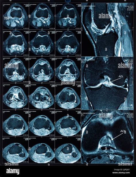 Knee Mri Magnetic Resonance Imaging Knees Mris Mri Scan Stock