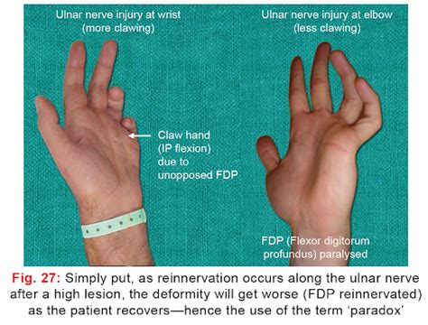 Ulnar Nerve Lesions Causes Diagnosis