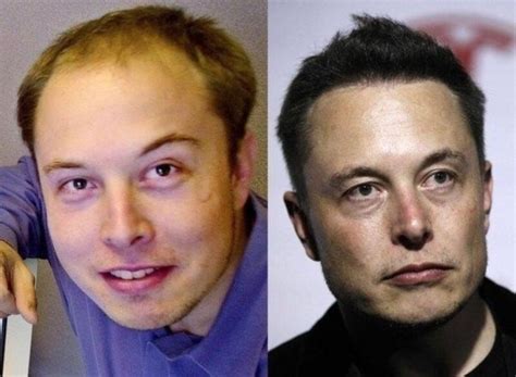 Real Truth About Elon Musk S Plastic Surgery Facelift Hair Transplant