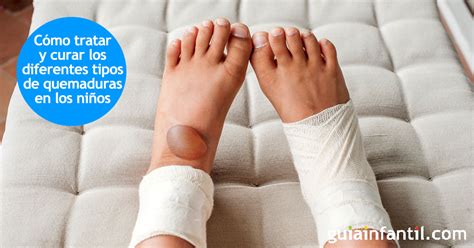 Cura de las heridas por quemaduras a los niños paso a paso