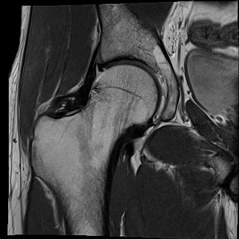 Normal Hip Mri Coronal View Diagram Quizlet