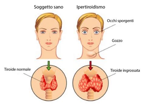 Ipertiroidismo Che Cosa E Le Cause I Sintomi La Diagnosi I
