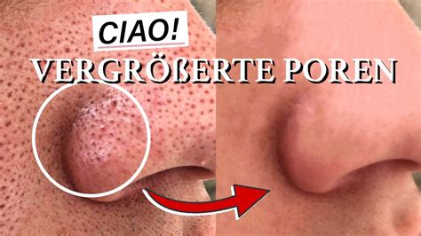 Kein Witz Vergrößerte Poren im Gesicht loswerden Große auf Nase
