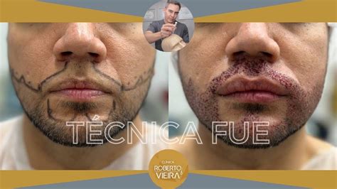 3 Casos De Transplante Capilar Em Barba YouTube