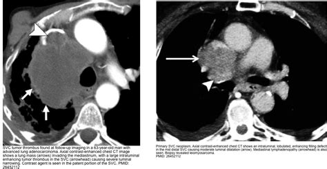 Pleural Effusion In Critically Ill Patients Recapem