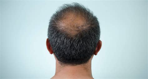 Quels Sont Les Premiers Signes D Une Calvitie Skin Clinic Paris