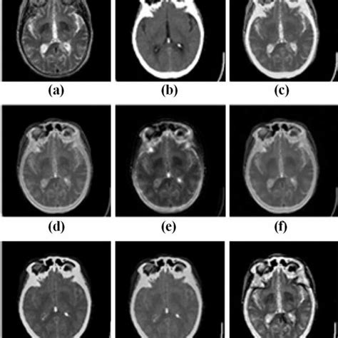 multi modality medical image fusion technique using multi objective differential evolution based