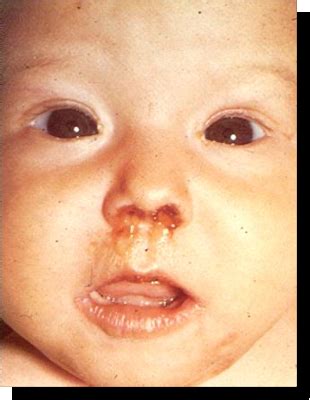 Micro Congenital Infections Flashcards Quizlet