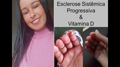 Raylene Esclerose Sistêmica Progressiva 924 YouTube