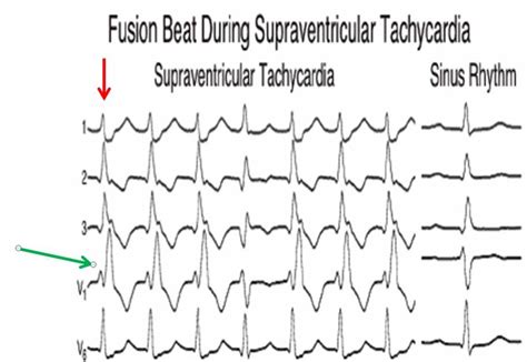 Dr Smith S ECG Blog Fusion Beat During Supraventricular Tachycardia