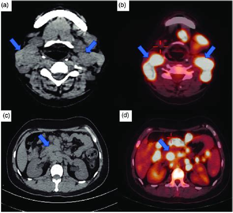 FDG PET And MR Images From Case 1 A B Enlarged Cervical Lymph Nodes