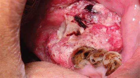 Early Throat Cancer Treatment