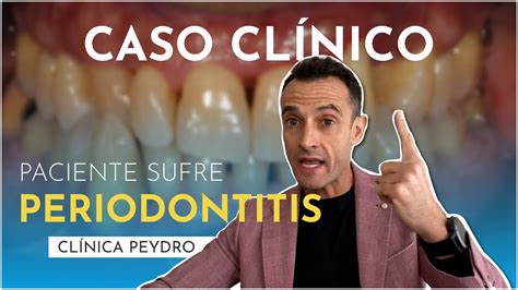 Todo Lo Que Debes Saber Sobre La Periodontitis Causas S Ntomas Y