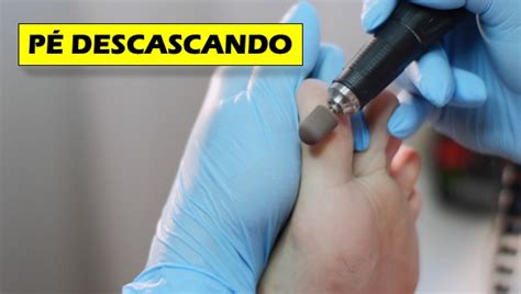 Sola do pé descascando o que pode ser Buscar Saúde
