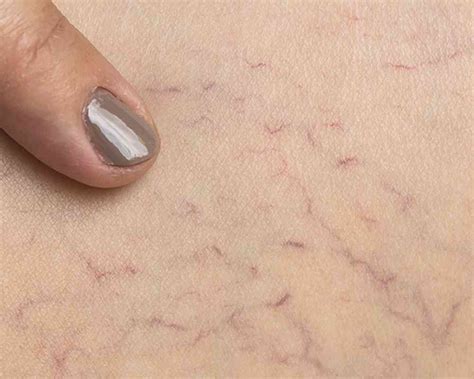 علت نمایان شدن مویرگهای پا دکتر توفیق متخصص واریس