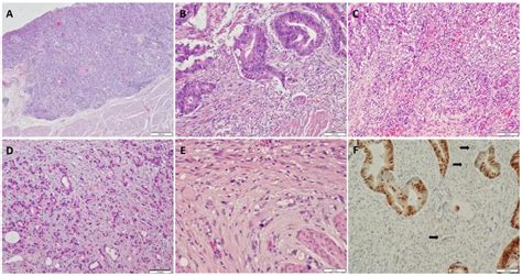 Histological And Immunohistochemical Features Of PT1 Colorectal Cancer