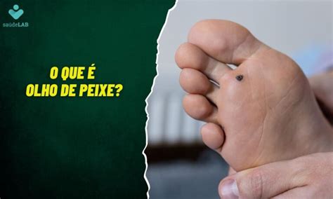 Olho de peixe saiba o que é as causas e o tratamento da verruga