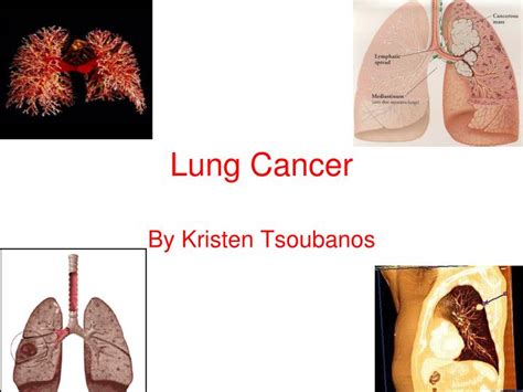Ppt Lung Cancer Powerpoint Presentation Free Download Id3665214