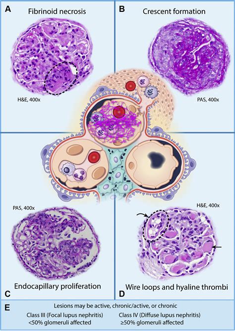 Classification Of Lupus Nephritis