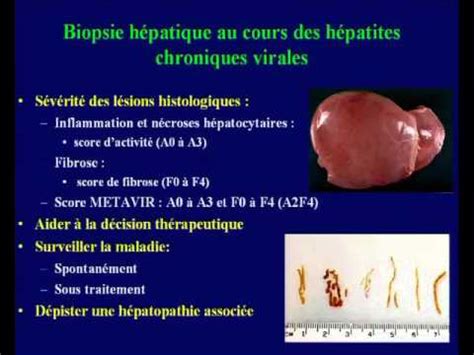 Evolution morphologique d une hépatite virale chronique YouTube