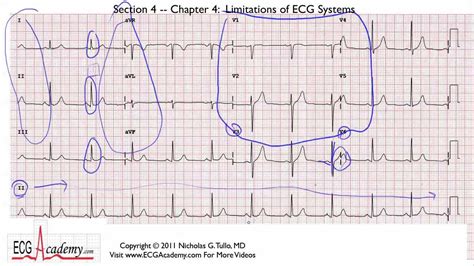 limitations of ecgs artifacts 4 4 ecg ekg interpretation basic youtube