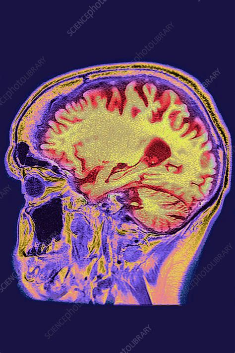 Cerebral Atrophy MRI Stock Image C044 8802 Science Photo Library