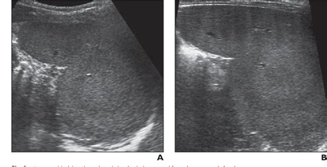 Normal Spleen Ultrasound