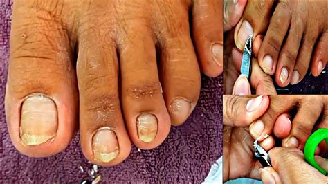 Satisfying Ingrown Toenail Removal Dry Skin Pedicure Youtube