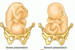 Vertex Position Fetal Position In
