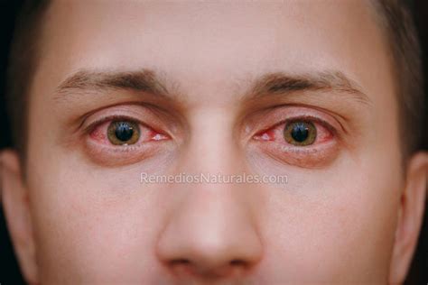 Conjuntivitis Alérgica Irritativa y Bacteriana Síntomas y