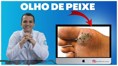 Verruga Plantar Olho De Peixe Causas Tratamentos E Preven O Guia