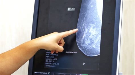 Gobernador Ciro Castillo Rojo inaugura mamógrafo digital 3D en Hospital