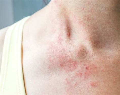 Leczenie AZS diagnostyka i objawy atopowego zapalenia skóry VIMED