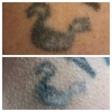 Tatoeage Verwijderen Behandelingen Beautycenter Neroli