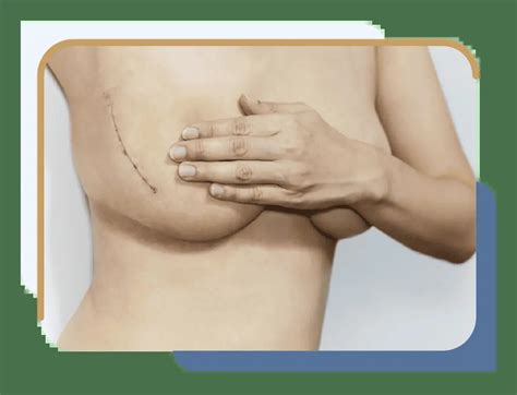 Unhappy With Breast Reconstruction After Mastectomy Next Steps With NYSHIP