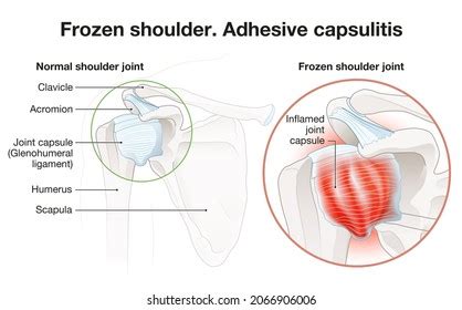 Illustration Showing Frozen Shoulder Adhesive Capsulitis Stock