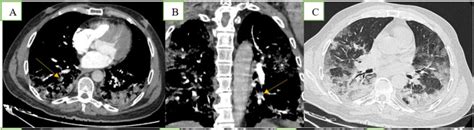 Computed Tomography Pulmonary Angiography CTPA A Axial And B