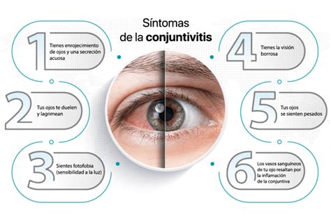 Blog Lentes De Contacto Y Conjuntivitis Verdades Y Soluciones