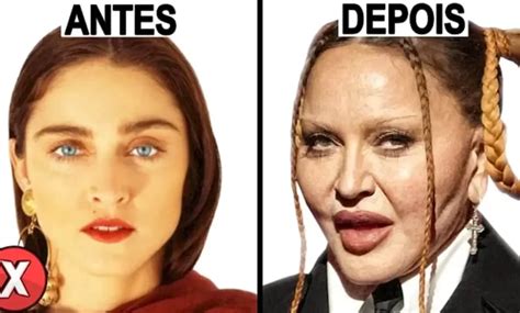11 FAMOSOS QUE FIZERAM HARMONIZAÇÃO FACIAL MAS ERAM MAIS BONITOS ANTES