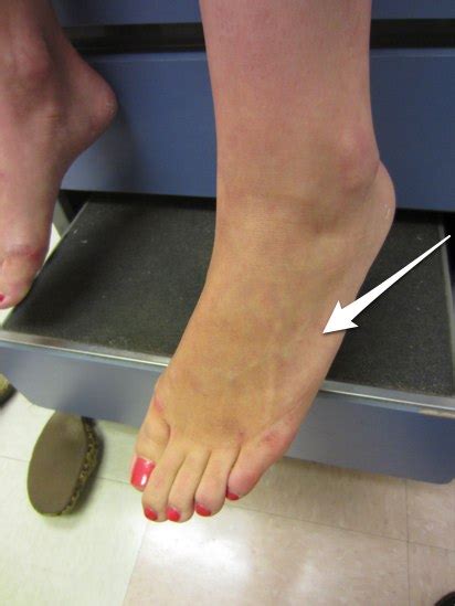 Stress Fractures Of The Foot Which Ones Are The Most Serious Dr Free