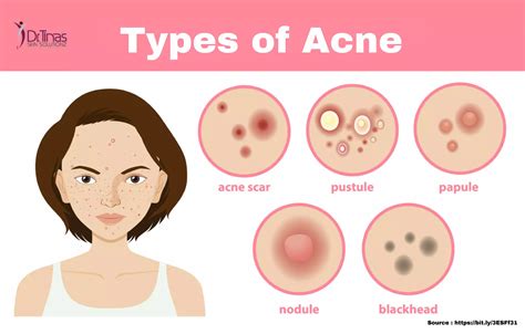 A Comprehensive Guide To Different Types Of Acne Breakouts On Your Face