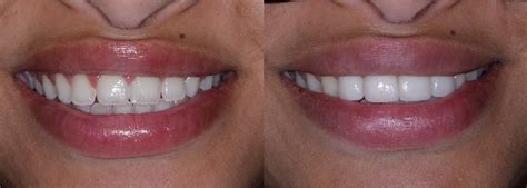 A Cosmetic Dentist Explains The Pros And Cons Of Veneers