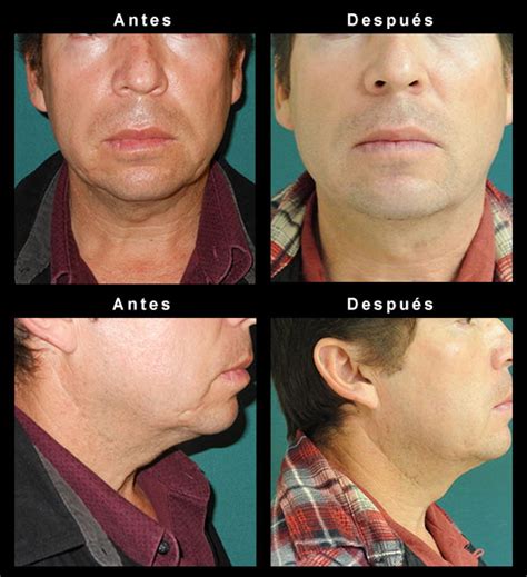 Tienda Tibio dolor de estómago radiofrecuencia rostro antes y despues