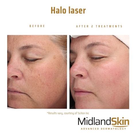 Halo Laser Midland Skin