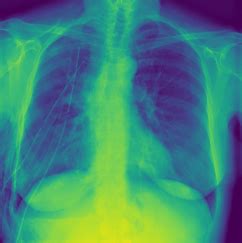 Identify Pneumothorax Disease Using Image Classification UNet Murtaza
