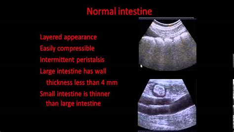 3 Role Of Intestinal Ultrasound In Imaging Of Bowel Disease Intestinal