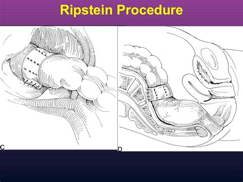 Rectal Prolapse Cedars Sinai Medical Center Medicine Resident Talk